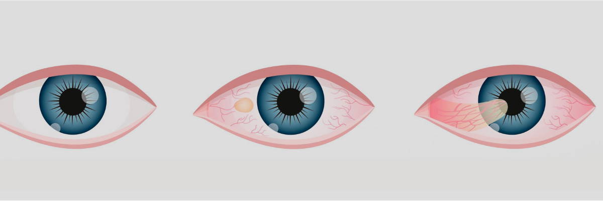 Esclera: Parte Branca do Olho e Doenças Relacionadas