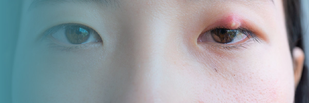 Blefarite: Como Cuidar das Suas Pálpebras | Médicos de Olhos