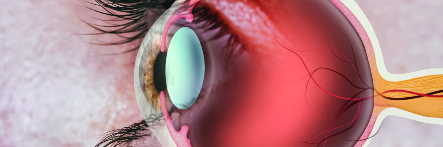 Retina: Funções, Doenças Comuns e Sinais de Alerta