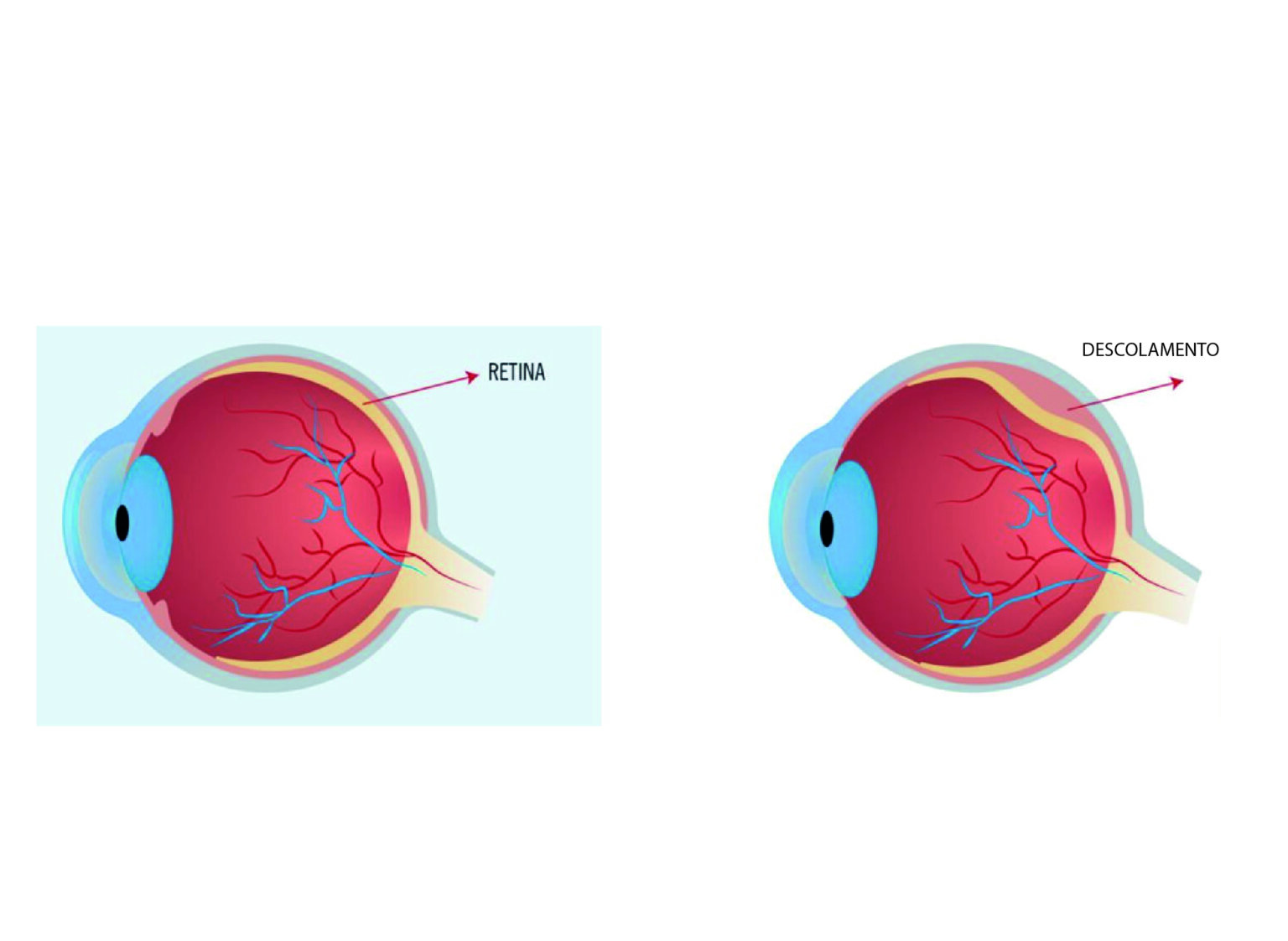 Sintomas de Descolamento de Retina: Atenção Urgente