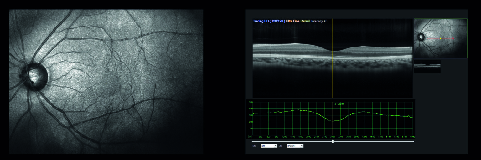 Retina: Funções, Doenças Comuns e Sinais de Alerta