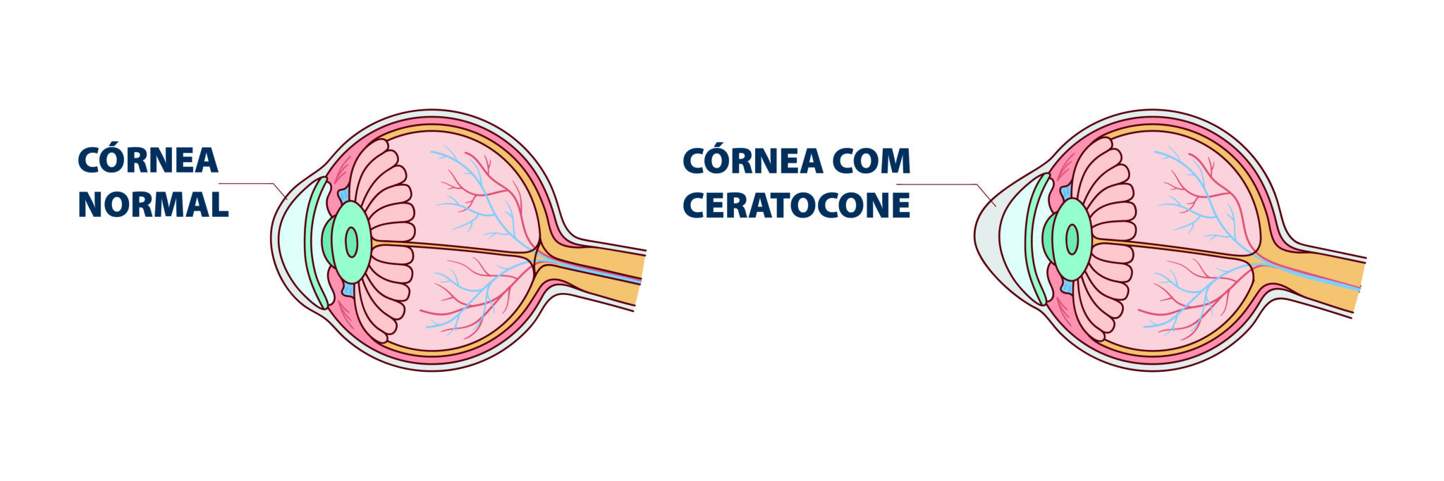 Crosslinking Corneano: Tratamento Eficaz do Ceratocone