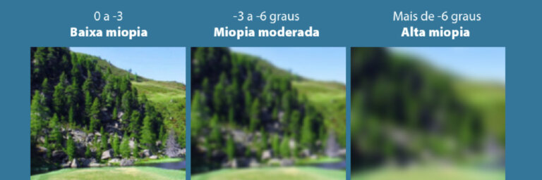 Graus de miopia: classificação e tratamentos | Médicos de Olhos