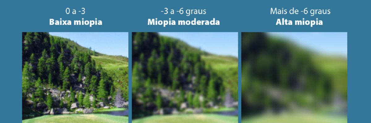Cirurgia de miopia: graus indicados e critérios